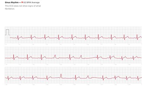 Intermittent S Wave Missing On Ecg Rafib