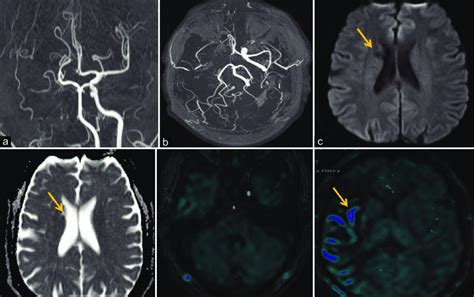 representative image of a patient in total occlusion group 3d tof mra