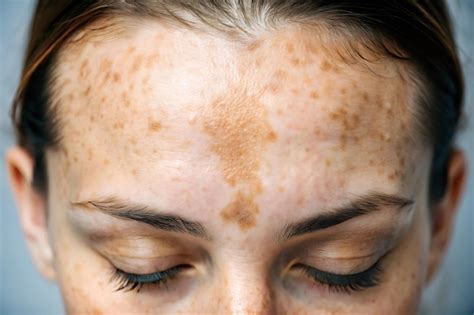 Close Up Of Hyperpigmentation On Forehead With Skincare Product Applied