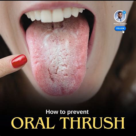 Did You Know A Common Fungus Can Cause White Patches In Your Mouth Making It Tough To Eat Or