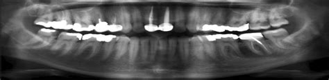 Use Of Cone Beam Computed Tomography In Diagnosing And Treat Journal Of Orofacial Sciences