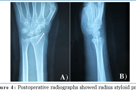 Radial Styloid Fracture Healing Time
