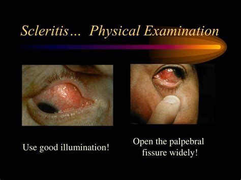 Ppt Scleritis Diagnosis And Management Powerpoint Presentation Id 5542222