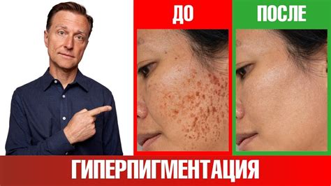 Пигментные пятна на лице: причины и лечение, как избавиться от ...
