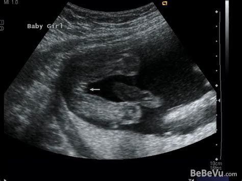 Determine The Sex Of A Baby Girl With Ultrasounds Artofit