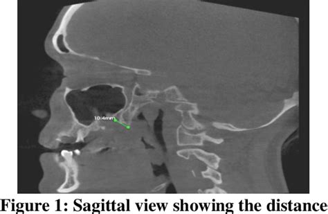 [pdf] The Role Of Cone Beam Computed Tomography In Determination Of The Greater Palatine Foramen