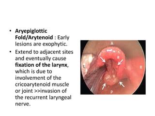 Laryngeal Cancer Management Pptx