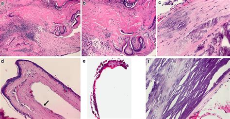 Tympanosclerosis A Middle Ear Mucosa With Stromal Hyalinization And