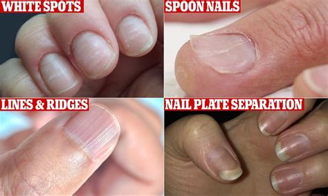 Nail Disorders Artofit