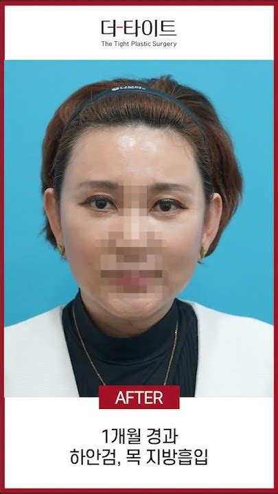 더타이트성형외과 하안검 목 지방흡입 전후사진 Youtube
