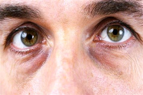 انتخاب بهترین کانسیلر برای پوشاندن تیرگی زیر چشم