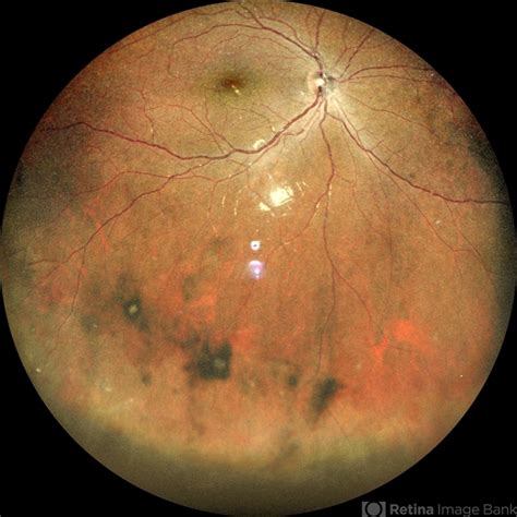 Intermediate Uveitis Retina Image Bank