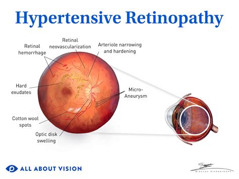What Is Hypertensive Retinopathy