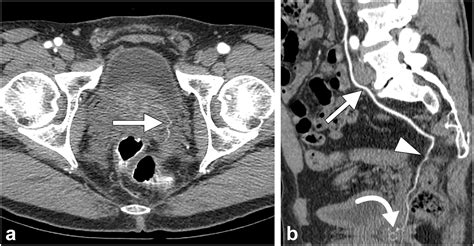 Rare Origin Of The Prostatic Artery From The Superior Rectal Artery Journal Of Vascular And