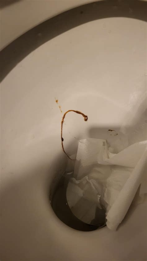 Please Are These Worms In Stool 🤢🤮😭 R Diagnoseme