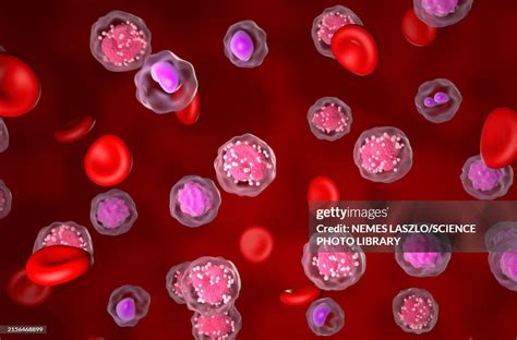 Acute Lymphoblastic Leukemia Illustration High Res Vector Graphic Getty Images