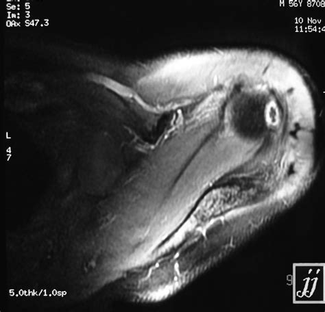 Sub Chondral Bone Defect Radiopaedia
