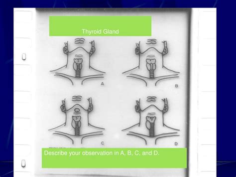 PPT Simple Nontoxic Goiter Diffuse And Multinodular PowerPoint Presentation ID