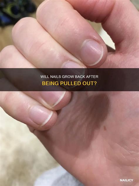Will Nails Grow Back After Being Pulled Out Nailicy