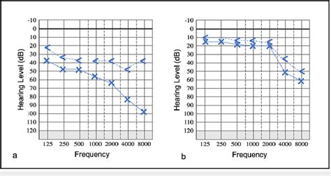 Pure Tone Audiometry Of The Left Side A Combined Hearing Loss At