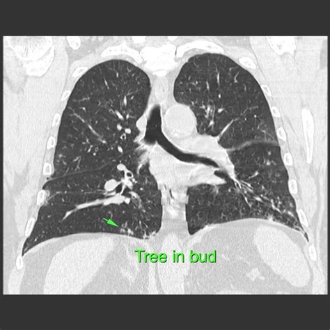 Tree In Bud Opacities He Is A Good Weblogs Image Archive