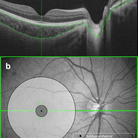 Measurement Of Choroidal Thickness Using Swept Source Optical Coherence Download Scientific