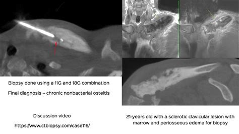 Case 116 Clavicular Lesion Biopsy