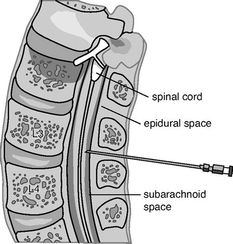 Subarachnoid Space Lumbar Puncture