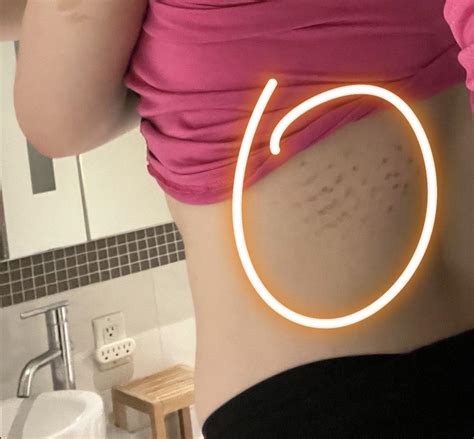 Weird Rash On Back R DermatologyQuestions