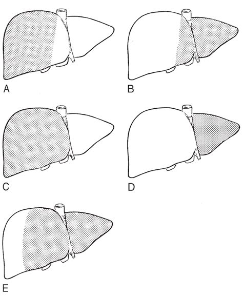 Commonly Performed Hepatic Resections Shown In The Shaded Areas A Download Scientific Diagram