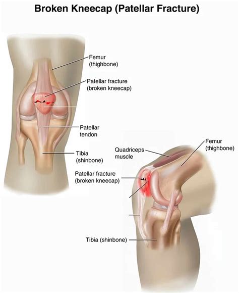 Patella Fracture Causes Types Symptoms Diagnosis Treatment And Recovery