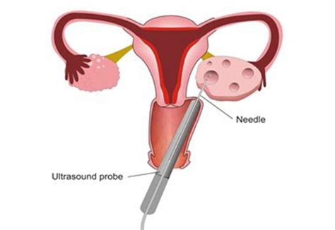 Infertility Specialist In Mumbai