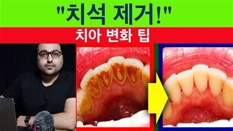 지 박사치아 플라크 충치 치은염에 대한 자연 요법 Youtube