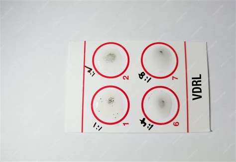 Premium Photo Rpr Vdrl Syphilis Test Glass Slide Agglutination Method Showing Reactive Result