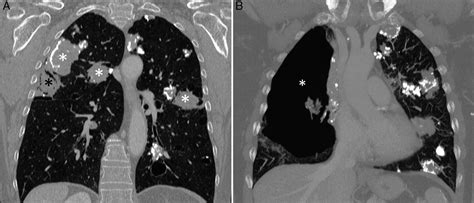 Loculated Secondary Spontaneous Pneumothorax A Very Rare Complication Of Nodular Pulmonary