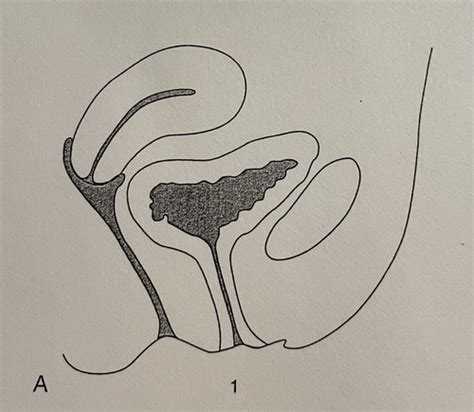 X Sec Uterine Positions W Pictures Flashcards Quizlet