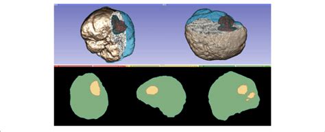 A Multi Tissue Brain Parenchyma Tumor Finite Element Mesh Used For Download Scientific