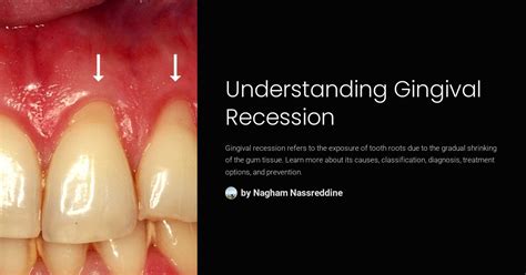 Understanding Gingival Recession