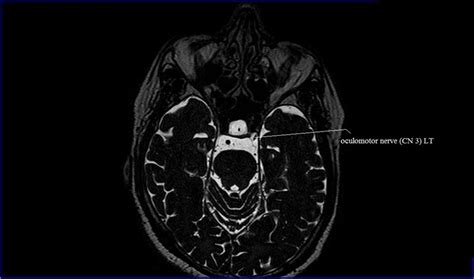 Brainstem Cranial Nerves Mri