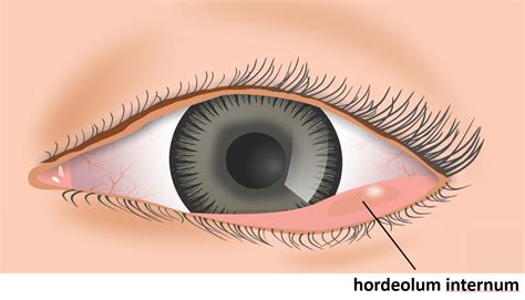 Hordeolum Internum Oorzaak And Symptomen Simptonl