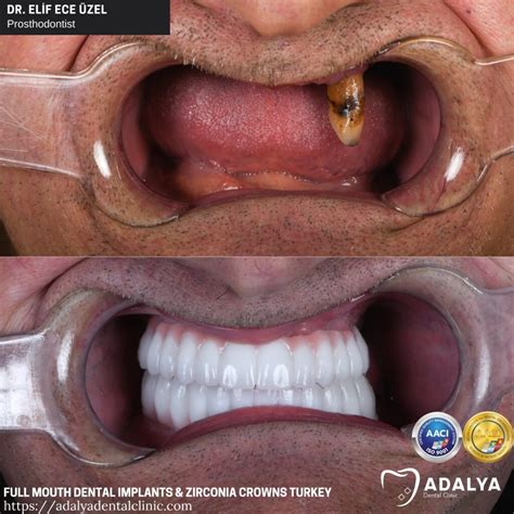 Dentistry Turkey Cosmetic Dentistry Antalya Adalya Dental Clinic