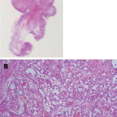 A Histological Classification Of Duodenal Polyps Download Table