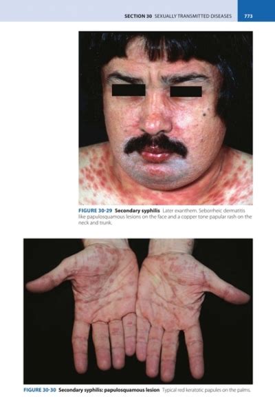 SECTION SEXUALLY TRANS