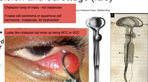 Oc Disease 1 Lecture 8 Infection Bacterial Dacryocystitis