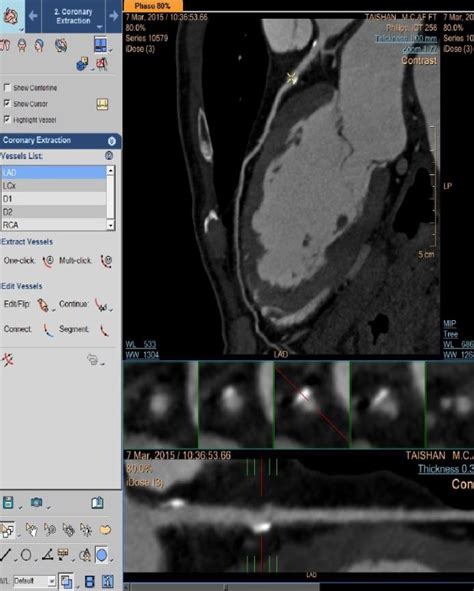 冠状动脉ct血管造影（冠脉cta） 医学影像部