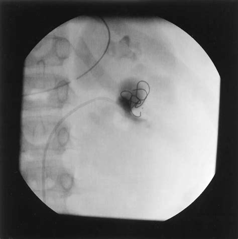 Selective Embolization Of The Pseudoaneurysm With Coils Download Scientific Diagram
