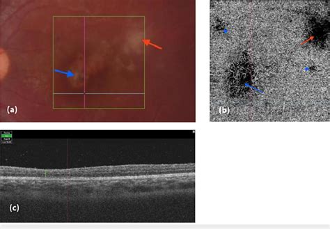 Right Eye Color Fundus Photo En Face Octa Of The Choriocapillaris And Download Scientific