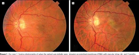 Figure 1 From Choroidal Neovascularization After Epiretinal Membrane Removal Semantic Scholar