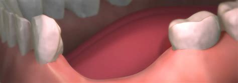 Ways To Prevent Bone Loss After Tooth Extraction Best Dental Clinic