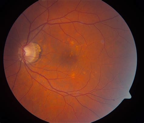 Multifocal Choroiditis Retina Image Bank